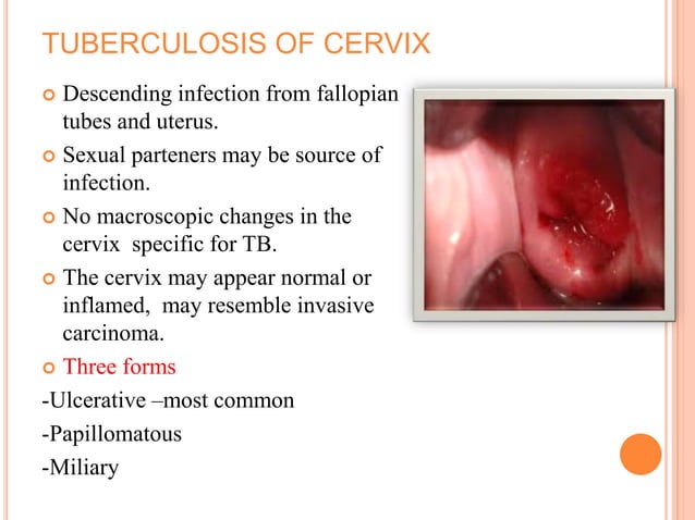 Genital Tuberculosis Ppt 1318
