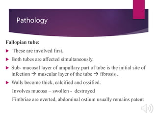 Genital tuberculosis | PPTX