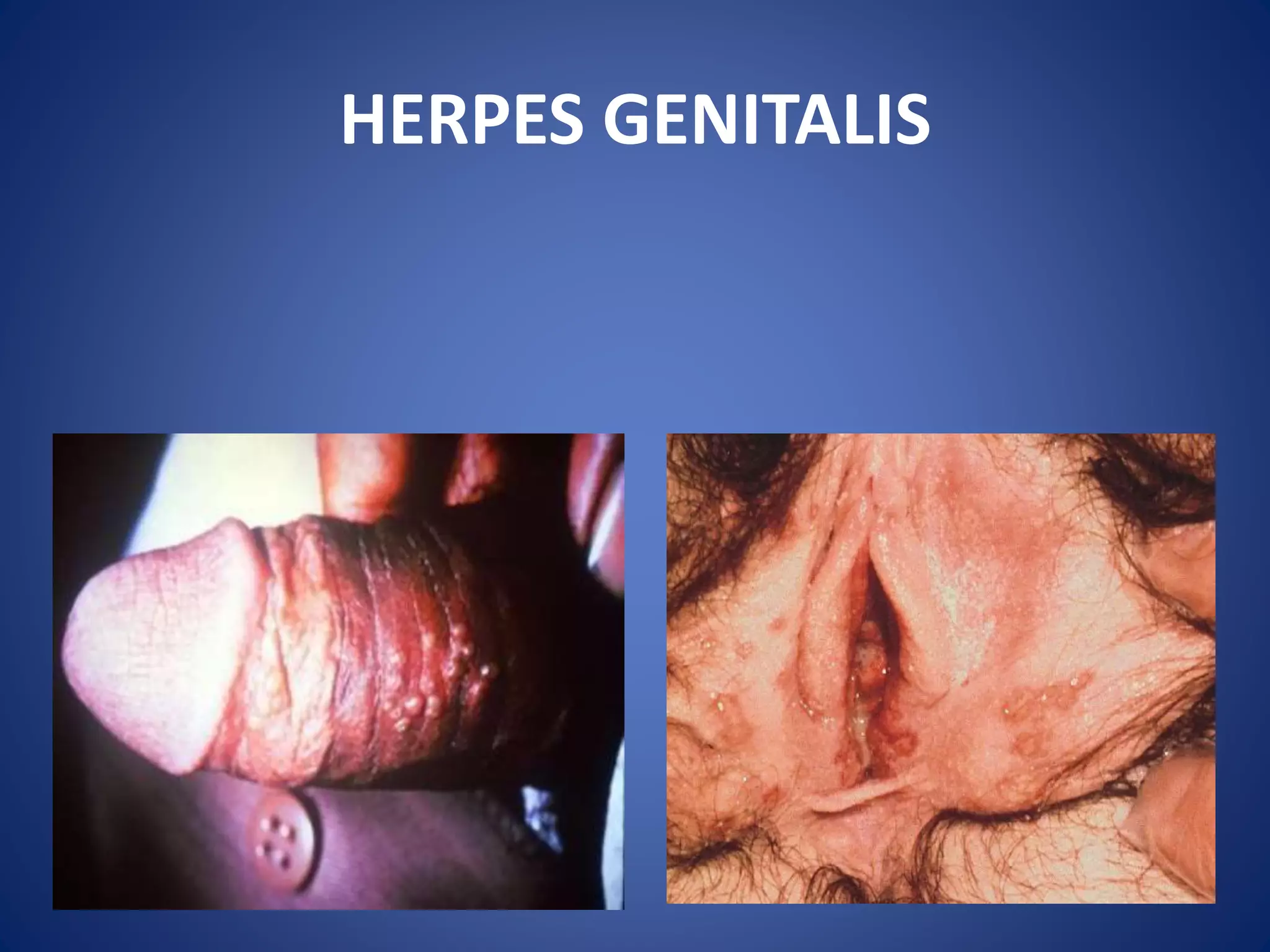 Genital ulcer disease | PPTX