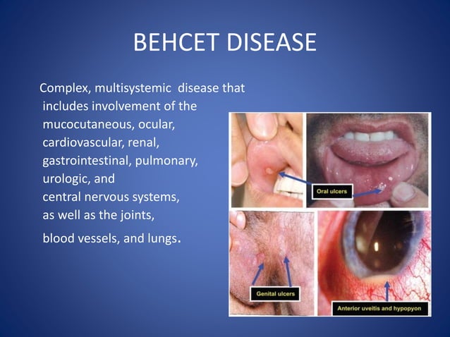 Genital ulcer disease