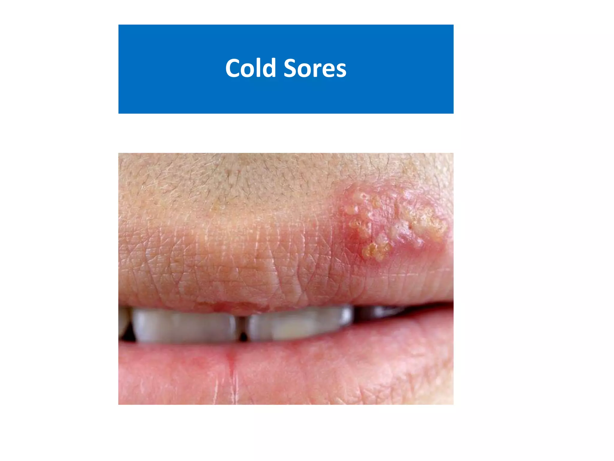 Genital ulcer syndro.pptx