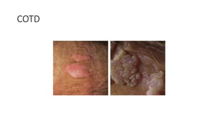 GENITAL WARTS. microbiology condylomata acuminata | PPTX