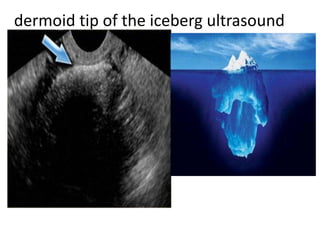 Tip Of The Iceberg Ultrasound