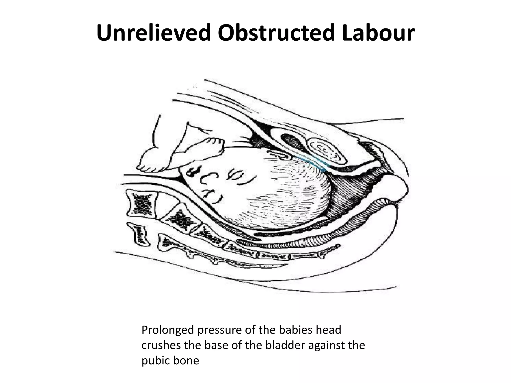 GENITO-URINARY FISTULA.pptx