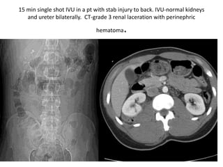 Genito-urinary trauma | PPT