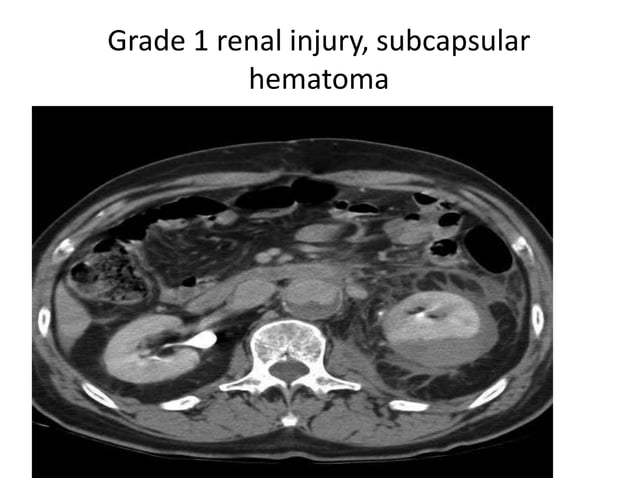 Genito-urinary trauma | PPT
