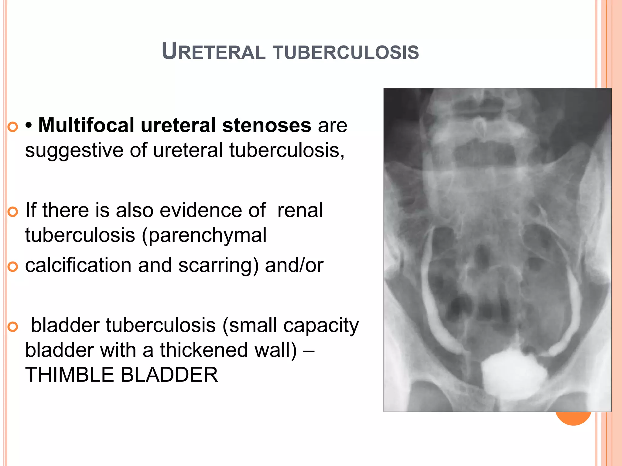genitourinary infection radiology.pptx