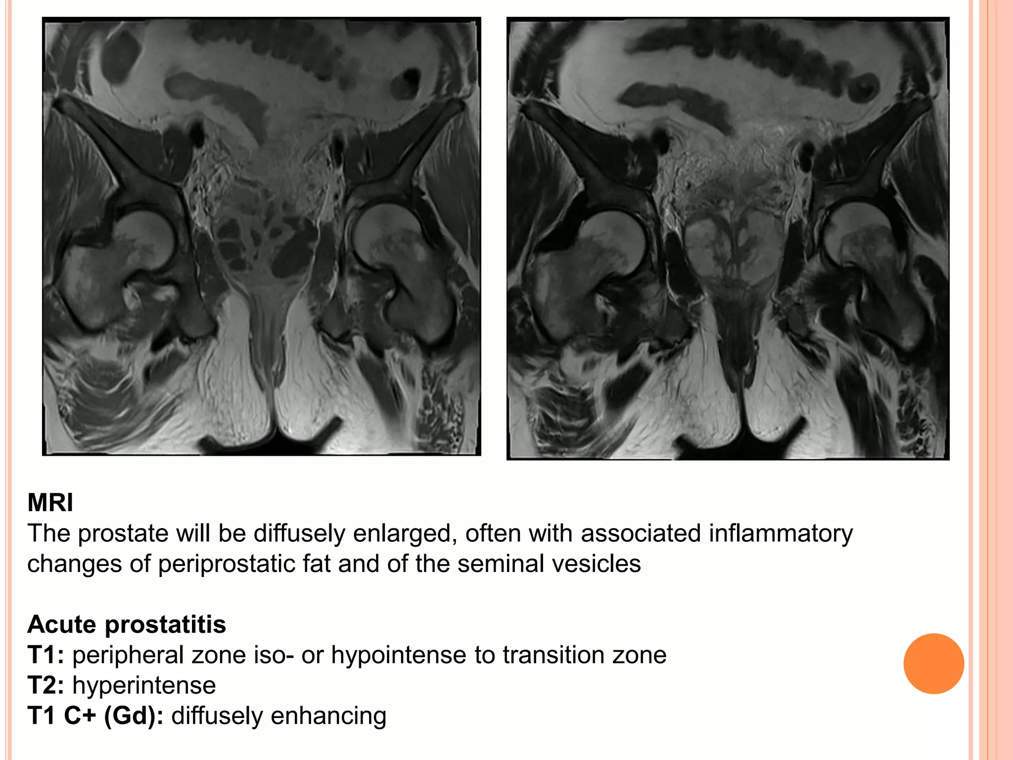 genitourinary infection radiology.pptx