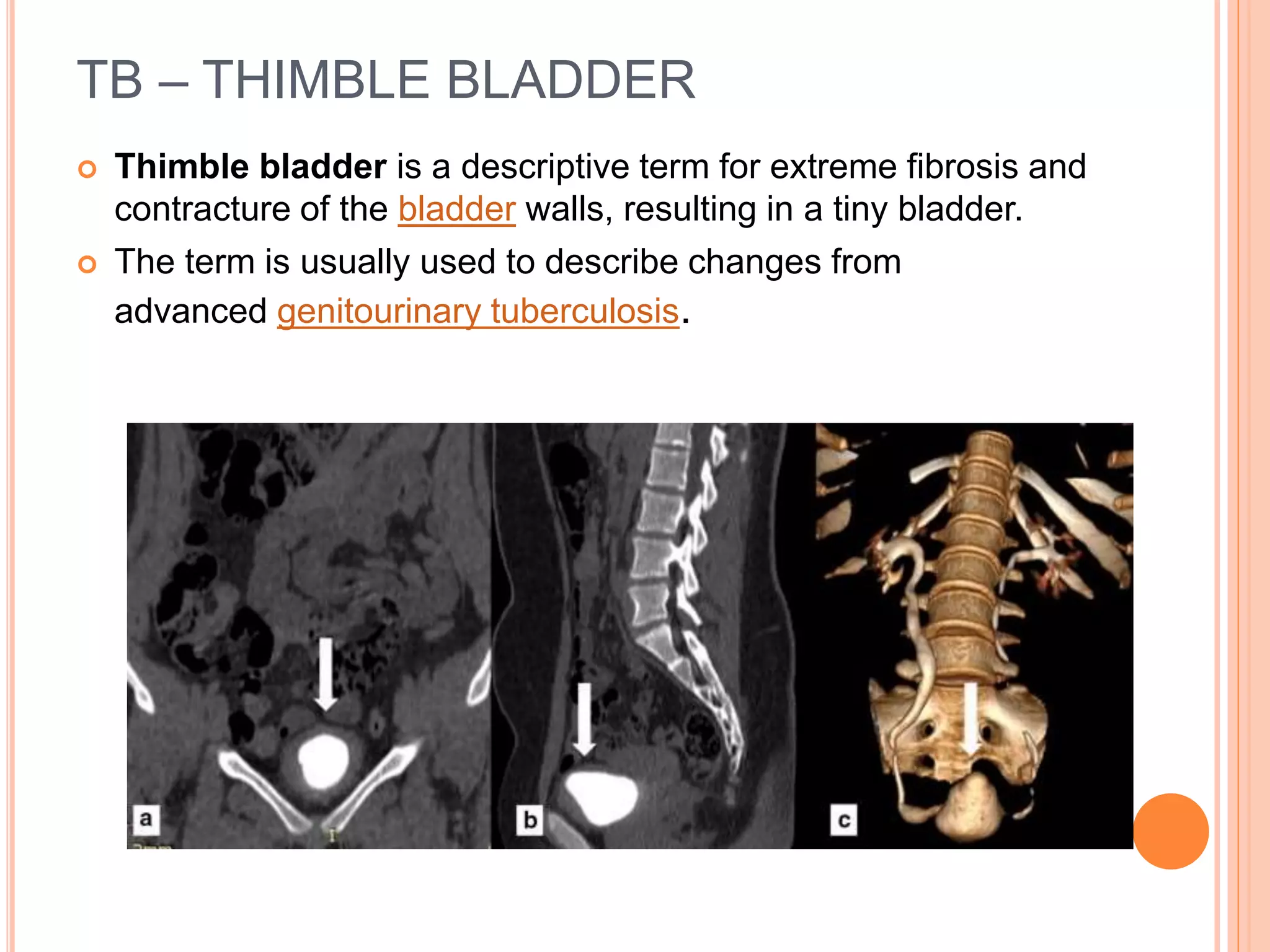 genitourinary infection radiology.pptx