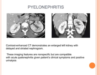 genitourinary infection radiology.pptx