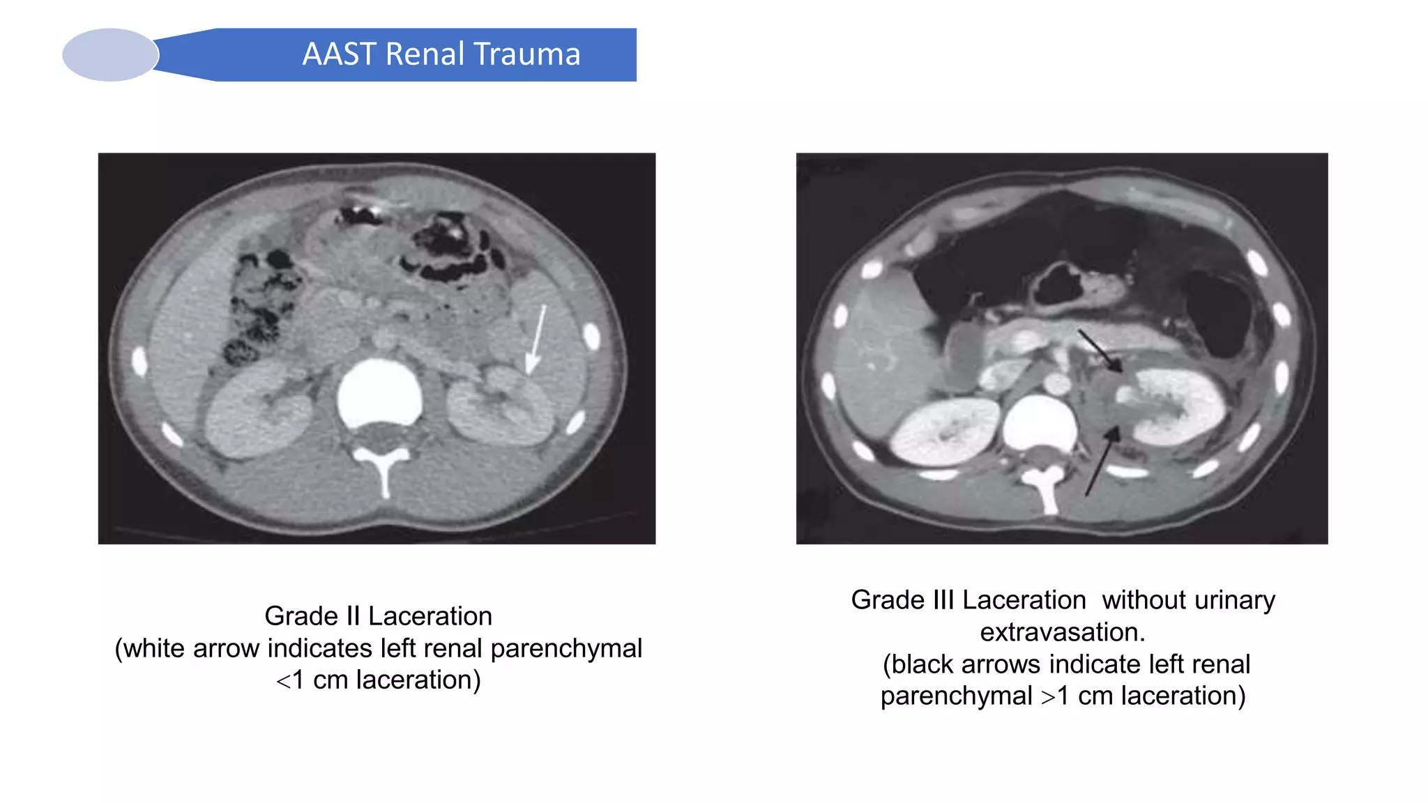 Trauma to Urinary Tract/ Urinary Tract Injury | PPTX