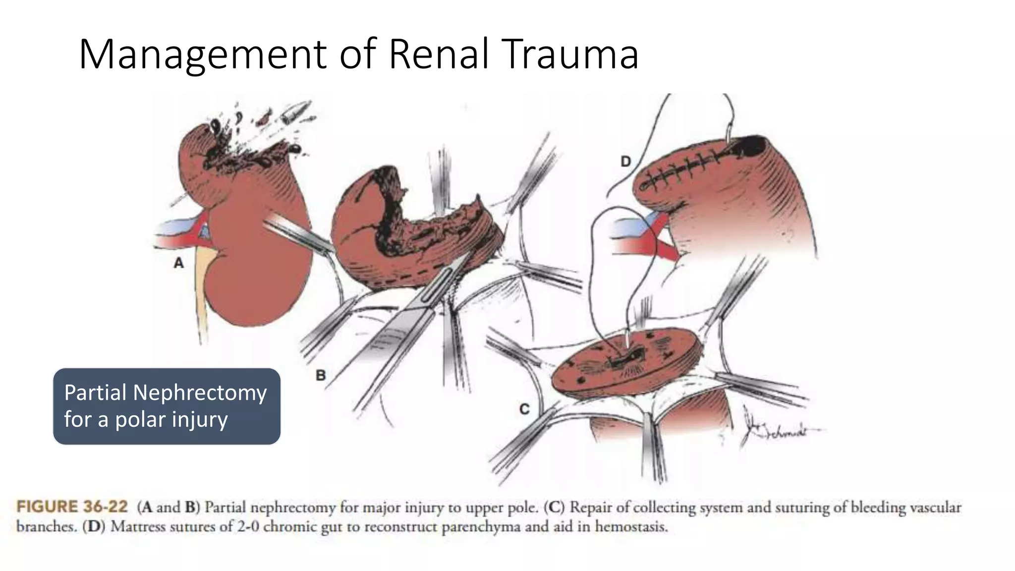 Trauma to Urinary Tract/ Urinary Tract Injury | PPTX