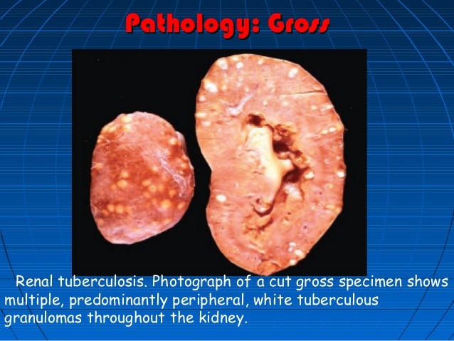 Genitourinary Tuberculosis