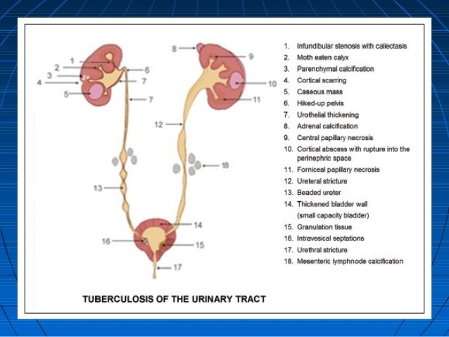 Genitourinary Tuberculosis