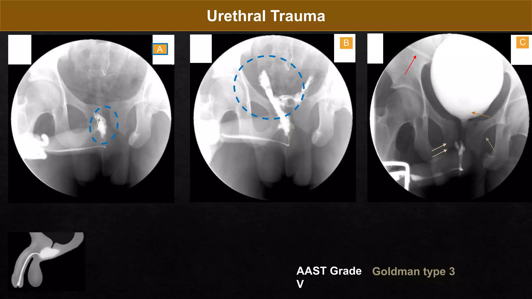 Genitourinary trauma.pptx