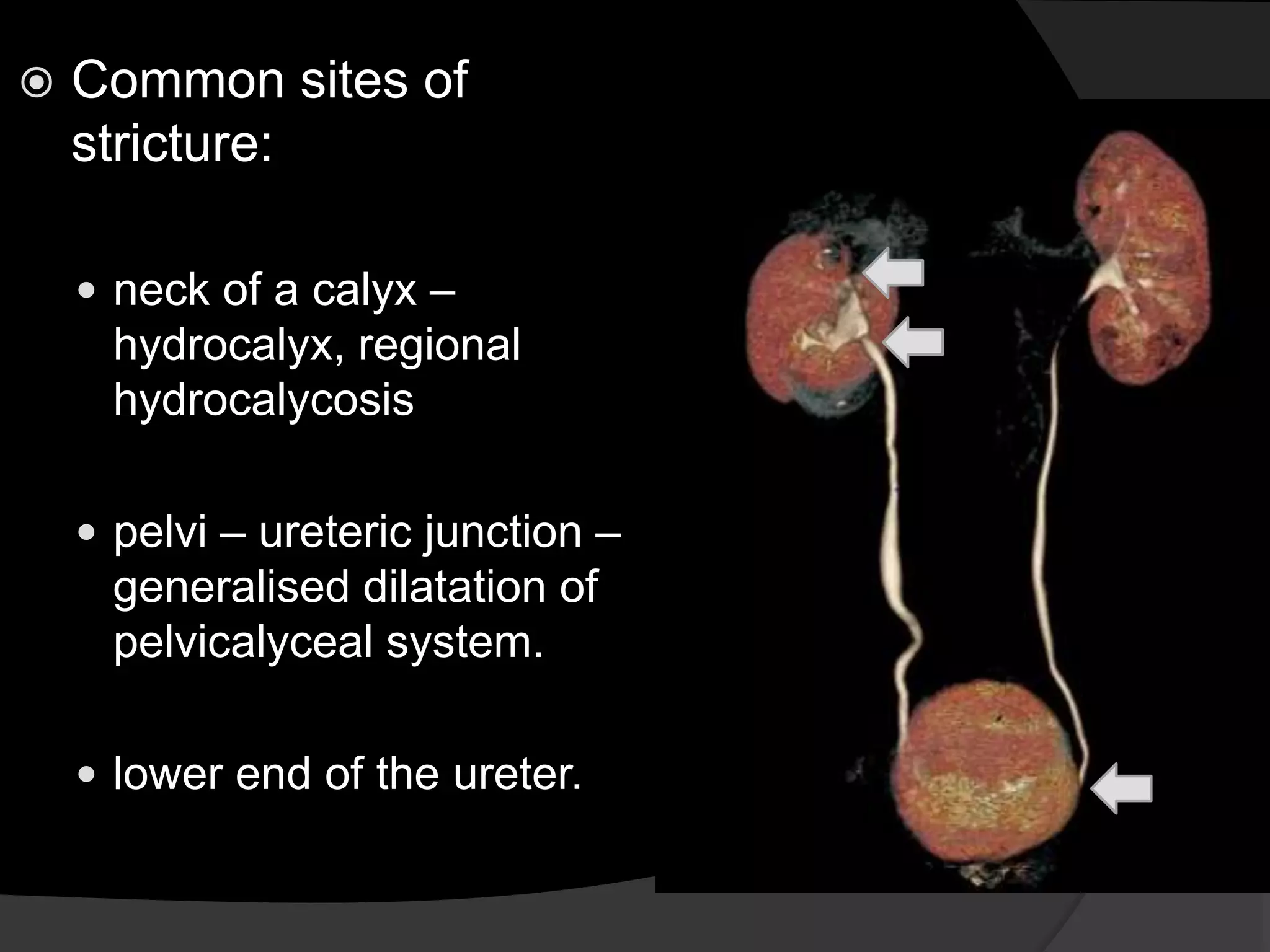Genito urinary tuberculosis | PPTX