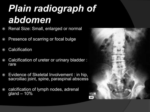 Genito urinary tuberculosis | PPTX | Digestive Disorders | Diseases and Conditions