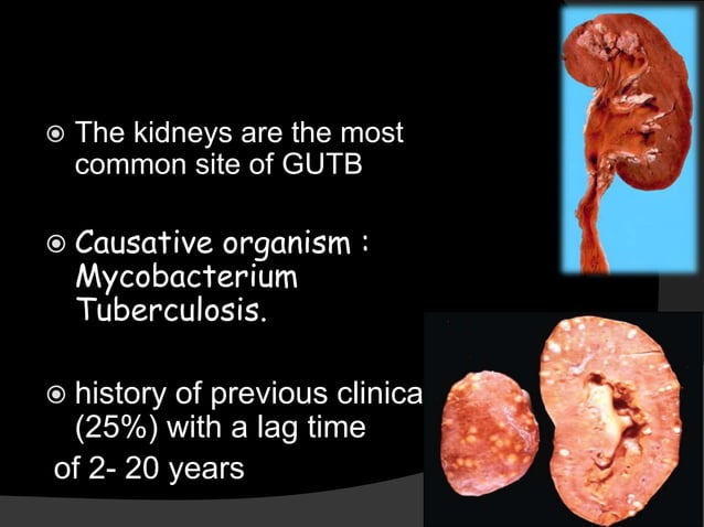 Genito urinary tuberculosis | PPTX | Digestive Disorders | Diseases and Conditions