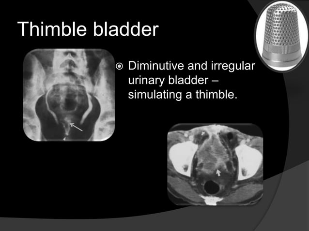 Genito urinary tuberculosis | PPTX | Digestive Disorders | Diseases and Conditions