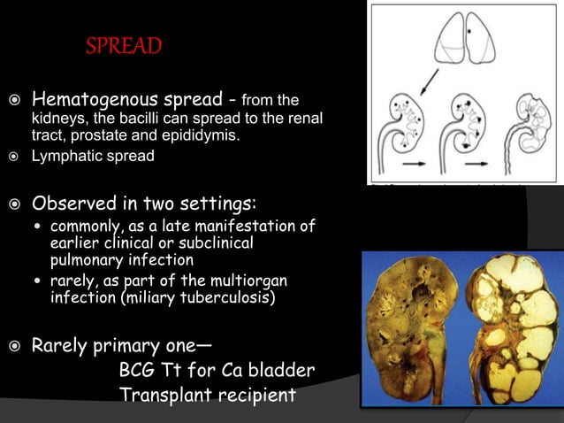 Genito urinary tuberculosis | PPTX | Digestive Disorders | Diseases and Conditions