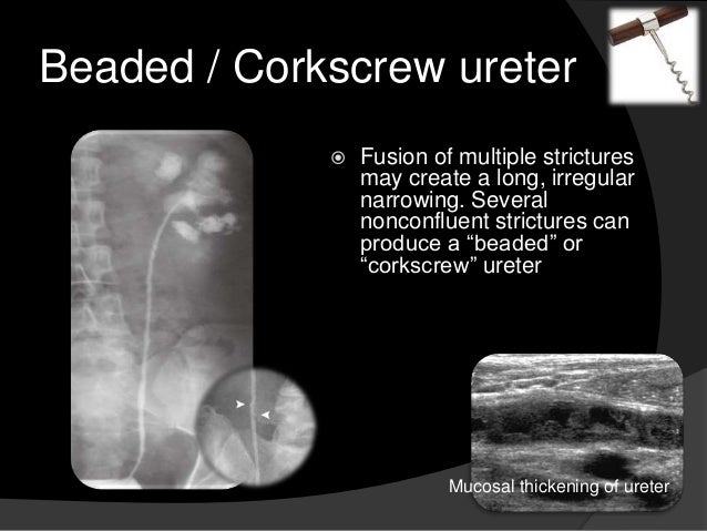Genito urinary tuberculosis