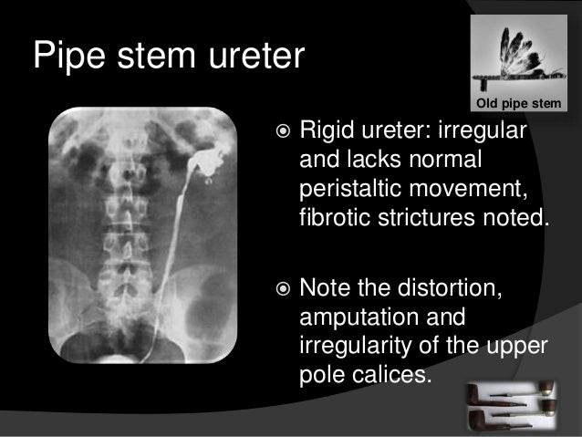 Genito urinary tuberculosis