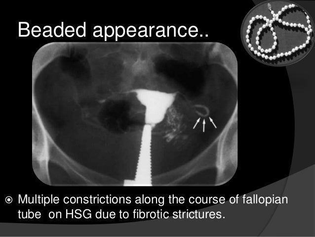 Genito urinary tuberculosis