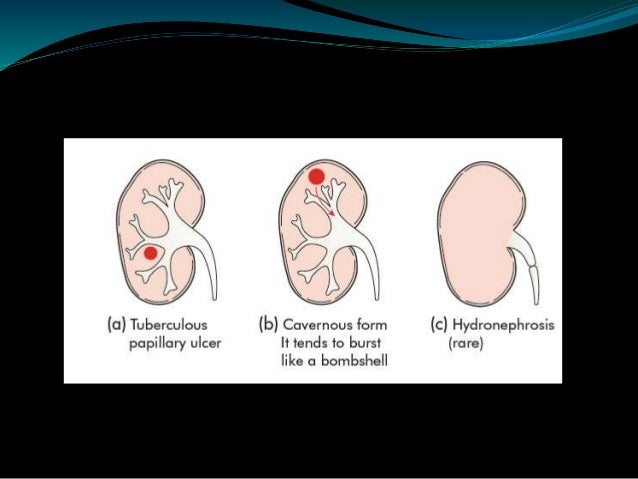 Genitourinary tuberculosis