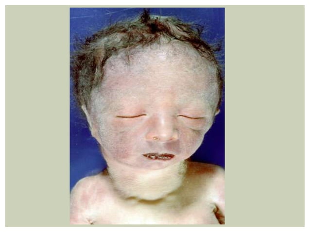 Edward syndrome | PPTX | Infertility | Reproductive Health