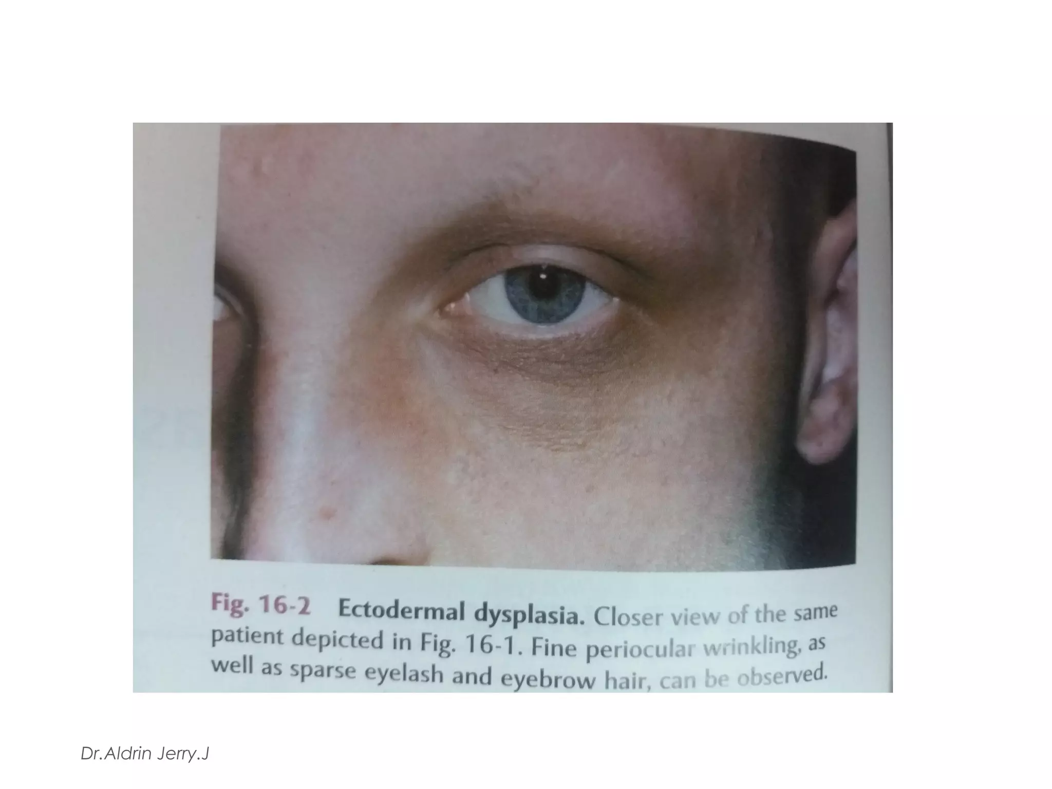 Genodermatoses - Oral Pathology | PPT