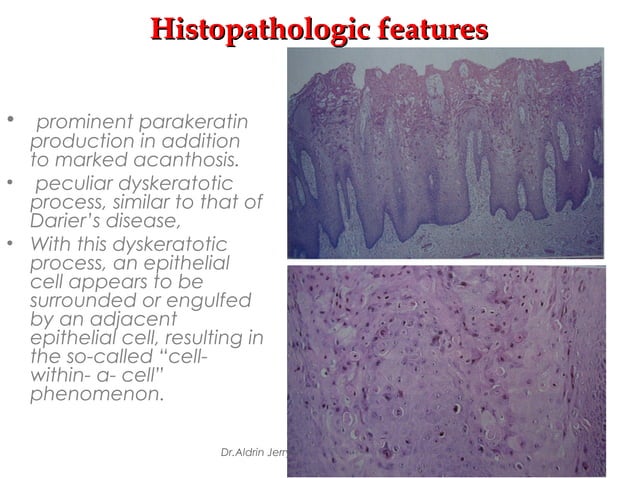Genodermatoses - Oral Pathology | PPT | Skin and Dermatology | Diseases ...