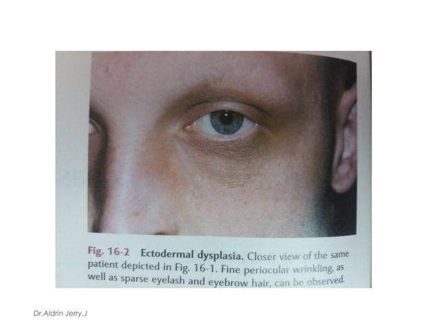 Genodermatoses - Oral Pathology | PPT | Skin and Dermatology | Diseases ...