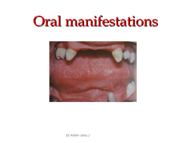 Genodermatoses - Oral Pathology | PPT | Skin and Dermatology | Diseases ...