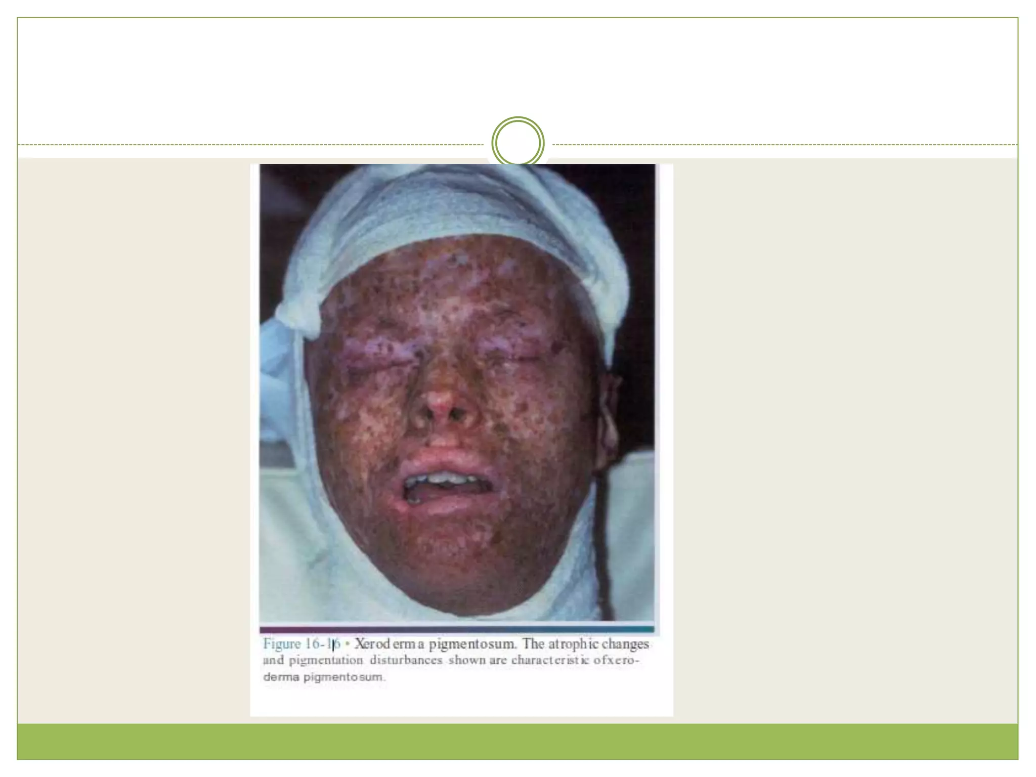 Genodermatoses | PPTX