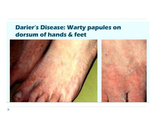 Genodermatoses.pptx | Skin and Dermatology | Diseases and Conditions