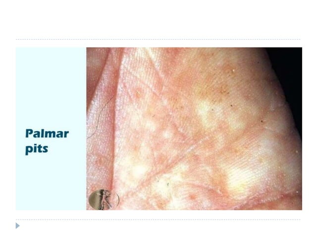 Genodermatoses.pptx | Skin and Dermatology | Diseases and Conditions