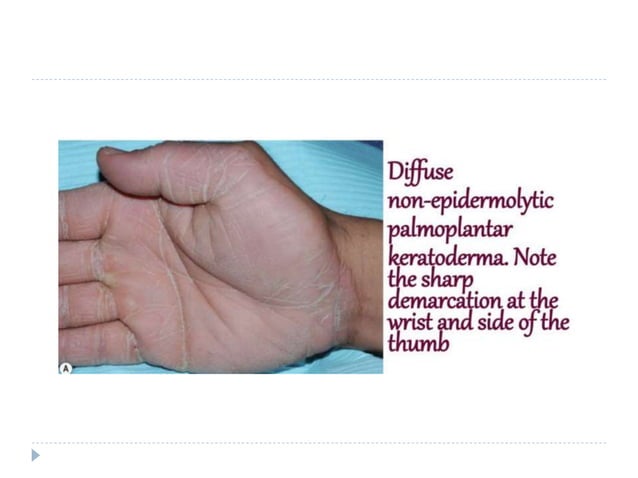 Genodermatoses.pptx | Skin and Dermatology | Diseases and Conditions