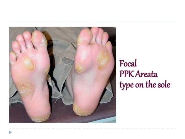 Genodermatoses.pptx | Skin and Dermatology | Diseases and Conditions