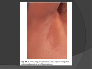 Genodermatosis | PPTX