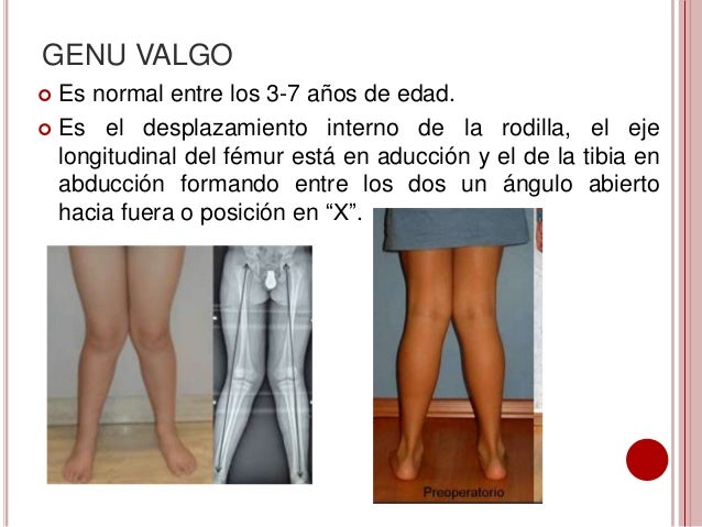 Geno varo y geno valgo ii