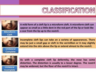 Cleft Palate | PPTX | Pregnancy | Reproductive Health