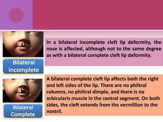 Cleft Palate | PPTX | Pregnancy | Reproductive Health