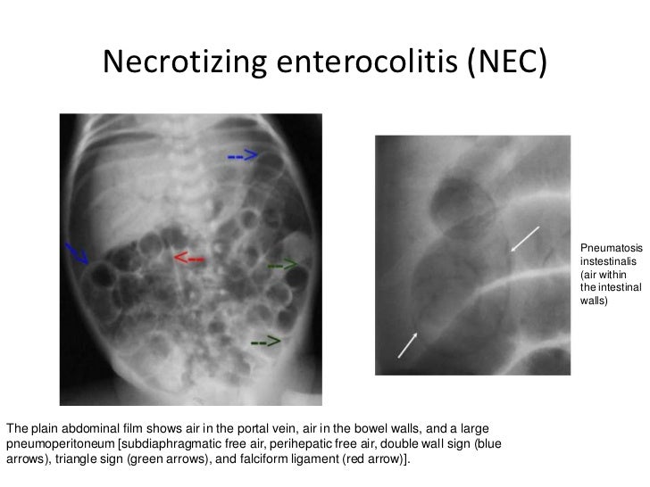 Necrotizing Enterocolitis Abdomen