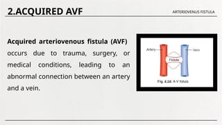 ARTERIOVENOUS FISTULA GENERAL SURGERY BY AKASH SURESH.pptx