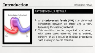 ARTERIOVENOUS FISTULA GENERAL SURGERY BY AKASH SURESH.pptx