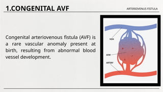 ARTERIOVENOUS FISTULA GENERAL SURGERY BY AKASH SURESH.pptx