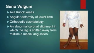 Genu Valgum.pptx