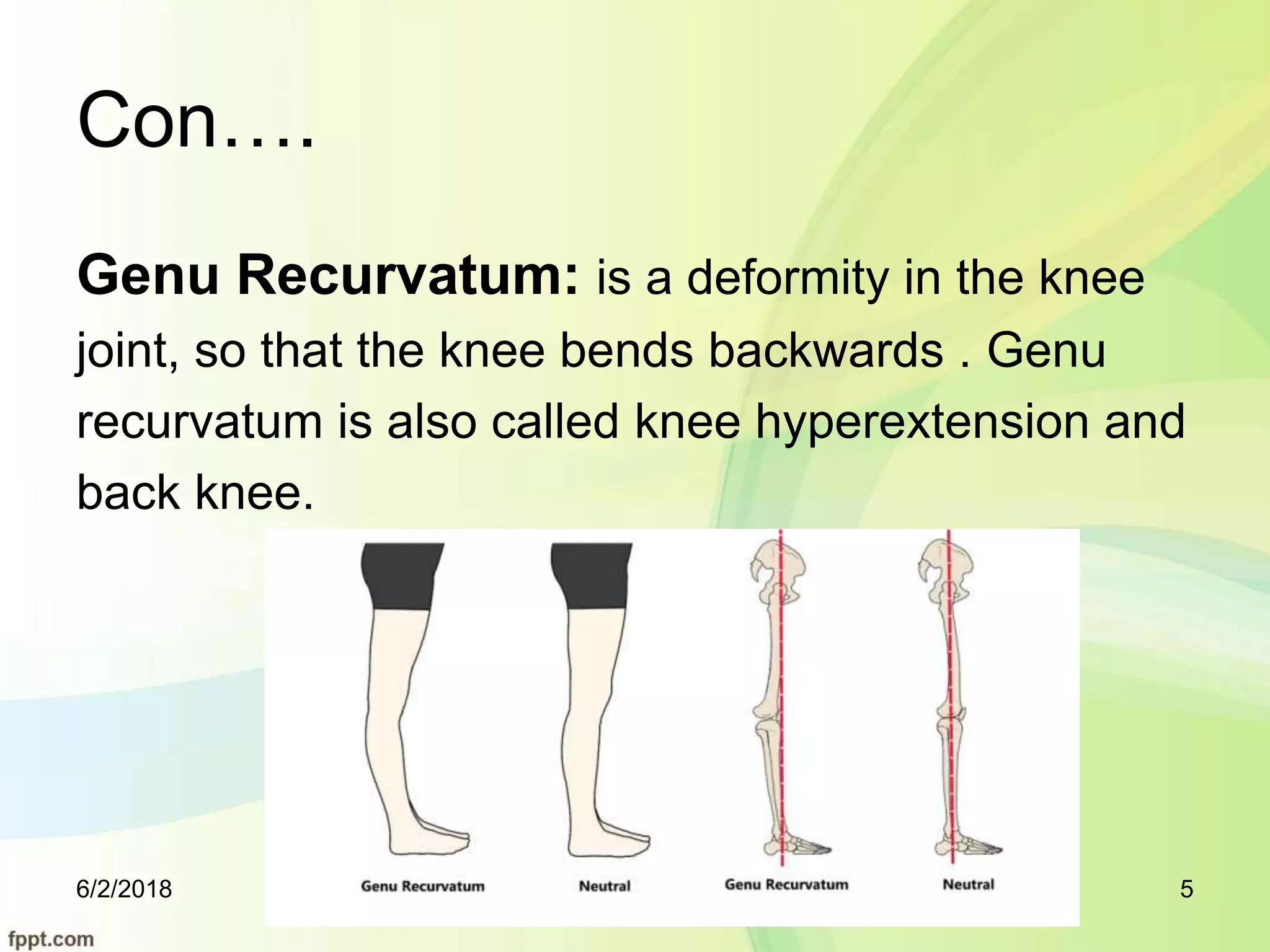 Genu recurvatum | PPTX