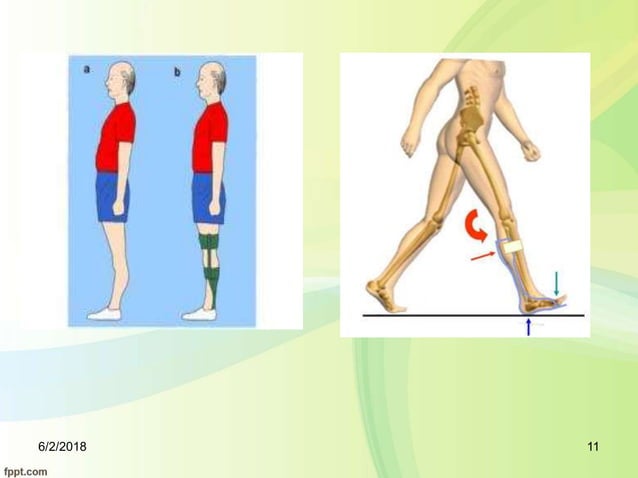 Genu recurvatum | PPTX
