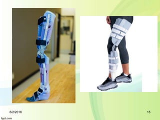 Mild Genu Recurvatum